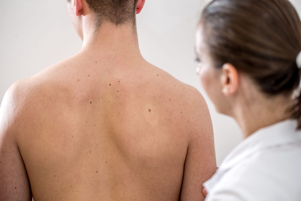Mole Mapping for Cancer Prevention - Kelowna, Calgary & Vancouver